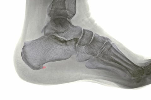 Espolón Calcáneo: Síntomas, Tratamiento y Prevención